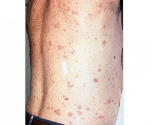 Scrub Typhus Outbreak Raises Concerns in Himachal Pradesh